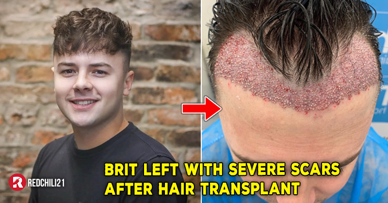 Young British Man Left With Horrific Scars After Hair Transplant in ...