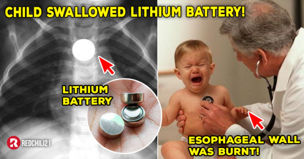 Child's Esophageal Wall Burnt Because Swallowed a Lithium Battery ...