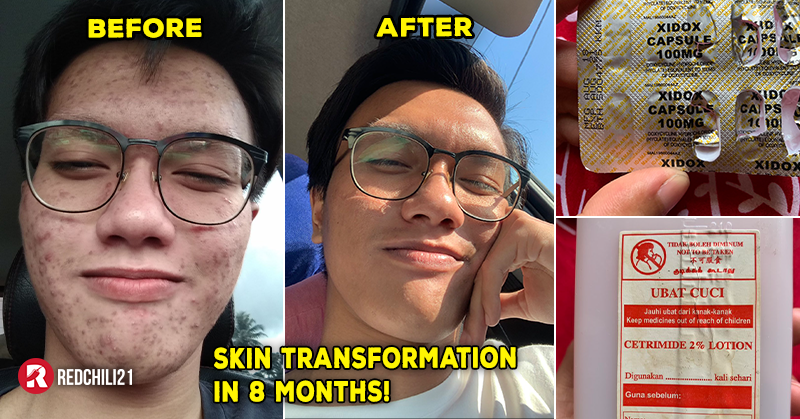 A Young Man Shared Skin Transformation In Just 8 Months! - RedChili21 MY